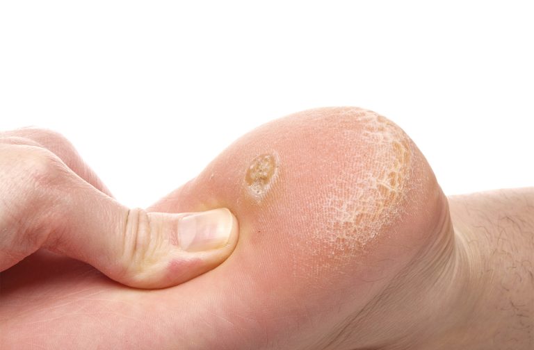 Verruca Removal - Can You Get Rid Of Verrucae? - The Healthcare Hub