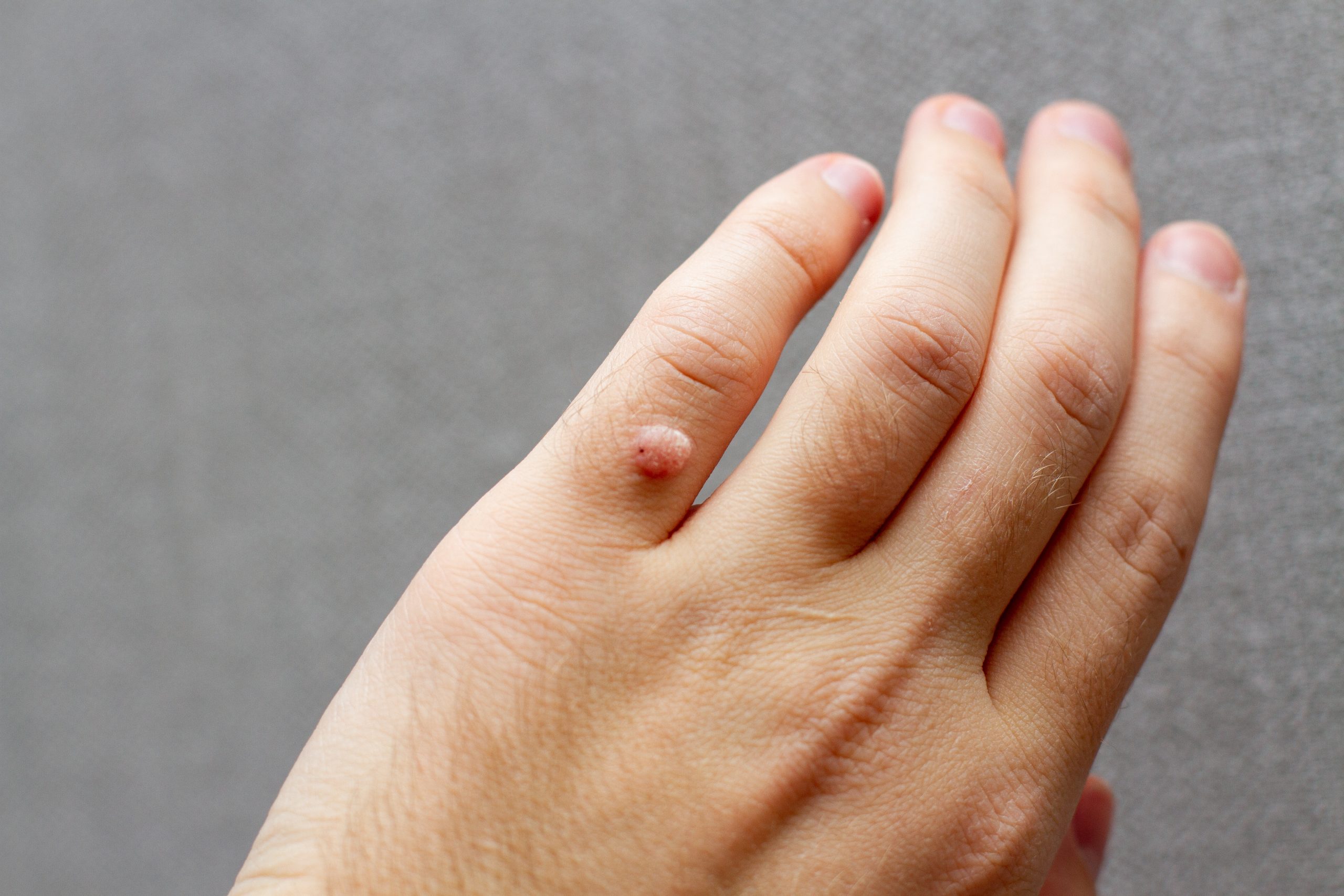 Pinky Wart Finger Wart On Hand The Healthcare Hub Pinky Wart Finger Wart On Hand The Healthcare Hub